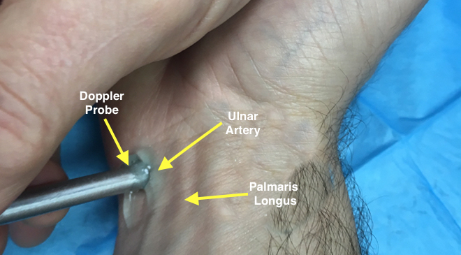 Ulnar Artery Pulse | Hand Surgery Resource